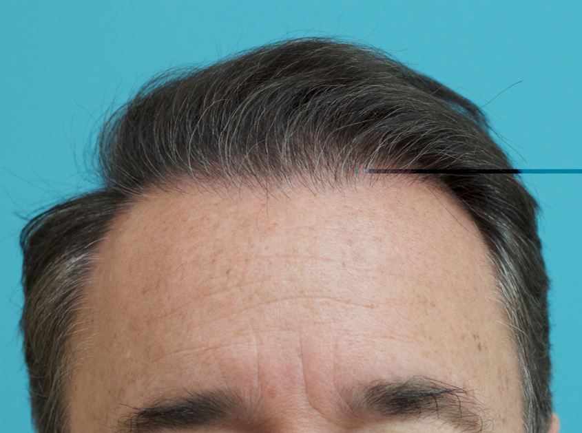 Hairline Gallery - Sara Wasserbauer MD