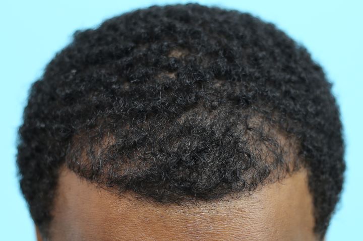 Hairline Gallery - Sara Wasserbauer MD
