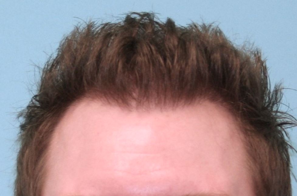 Hairline Gallery - Sara Wasserbauer MD