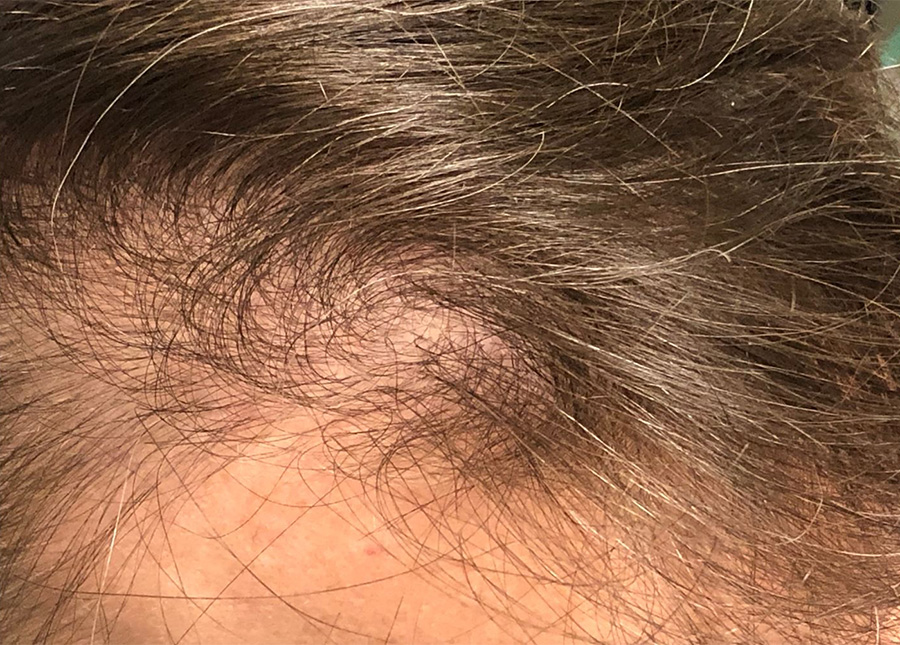 Can you Guess if this is a Hair Transplant? - News - Sara Wasserbauer MD