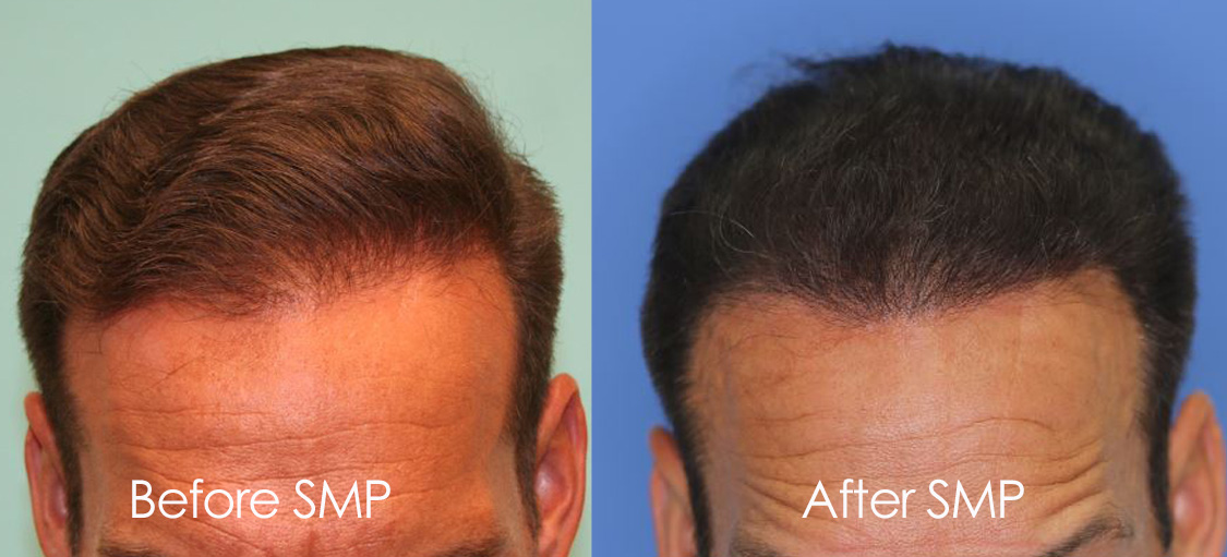 Scalp Micropigmentation - SMP - Before & After Photos - California Hair