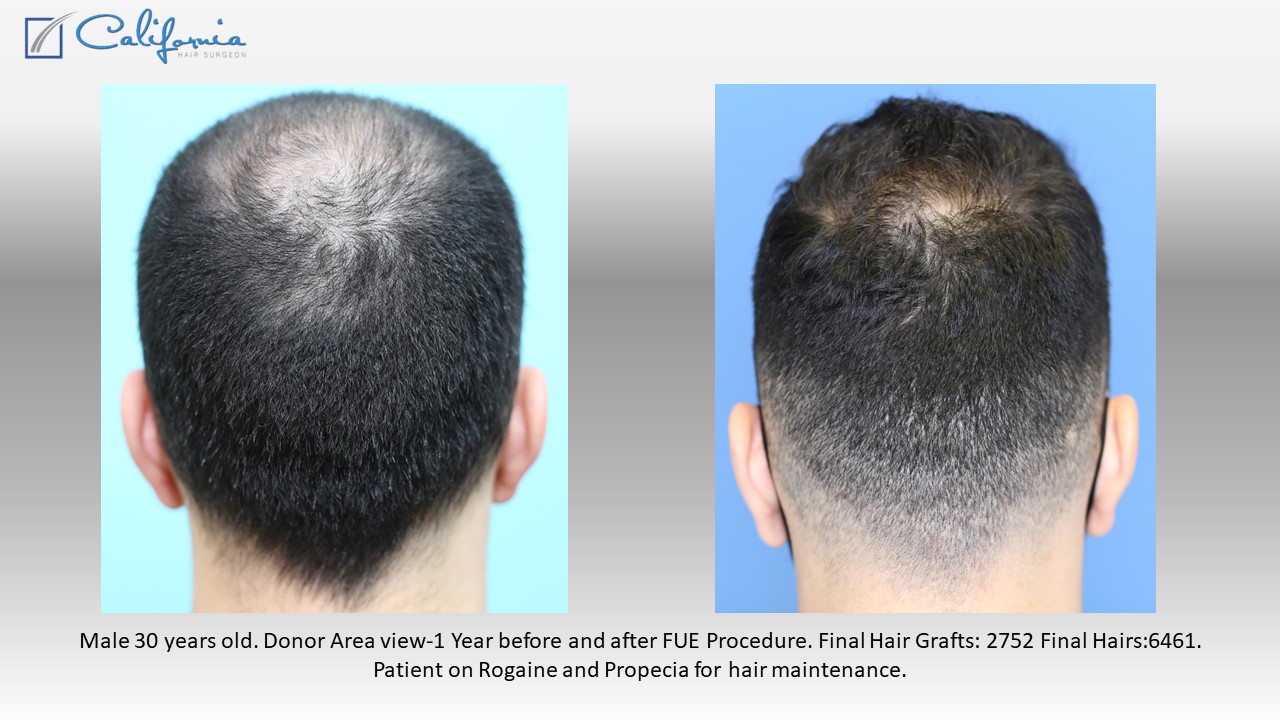 Hair Growth Time Lapse Case Study Case Study Sara Wasserbauer MD Hair Growth Time Lapse Case Study Case Study Sara Wasserbauer MD