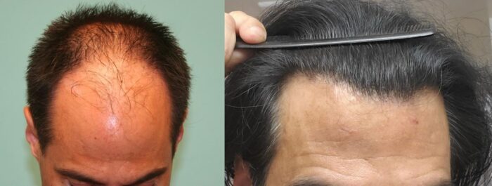 Dense Hair Restoration with Combination Procedures - Case Study - Sara ...
