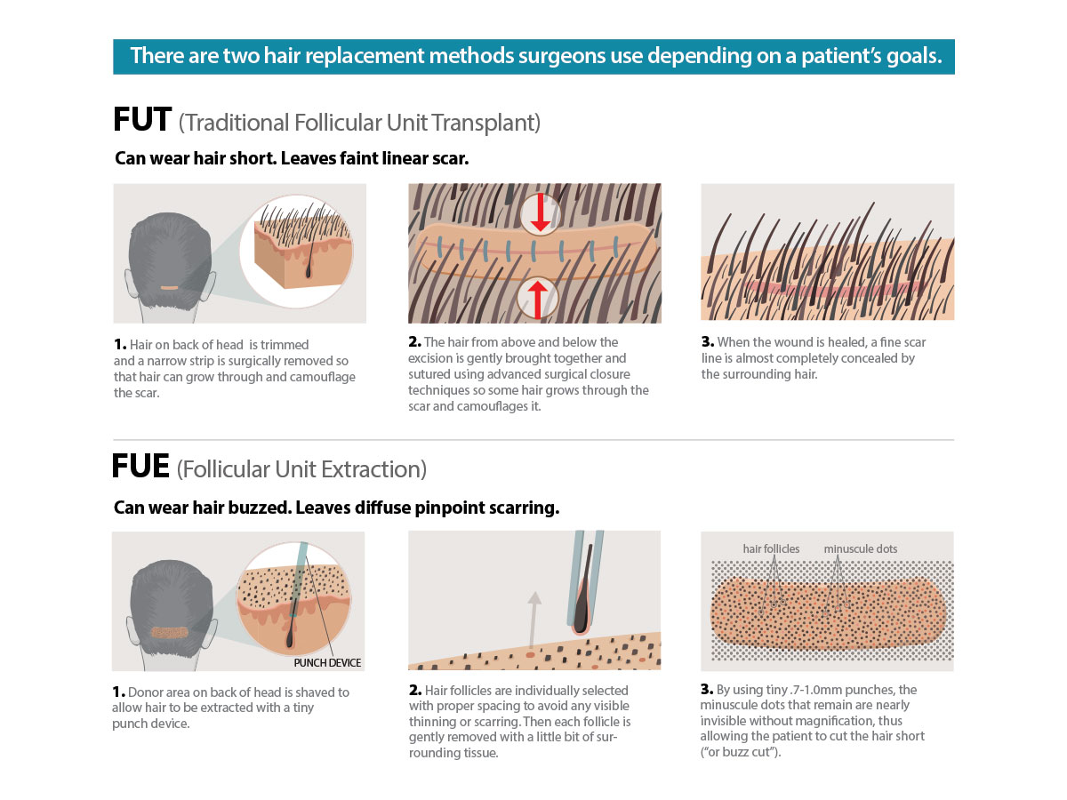 What is Follicular Unit Extraction (FUE)? - News - Sara Wasserbauer MD